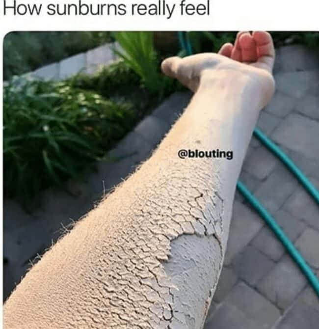 35 Funny Sunburn Memes For Us Pale-Skinned Summer Warriors Who Don't Tan, We Roast